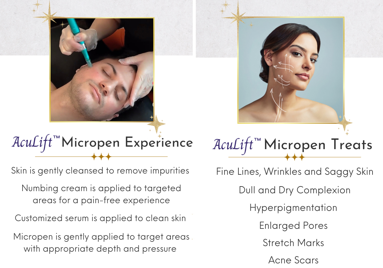 MicroNeedling - On Point Health Acupuncture