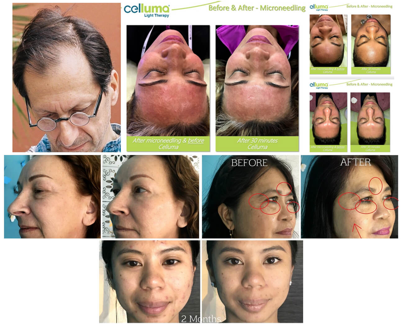 MicroNeedling - On Point Health Acupuncture